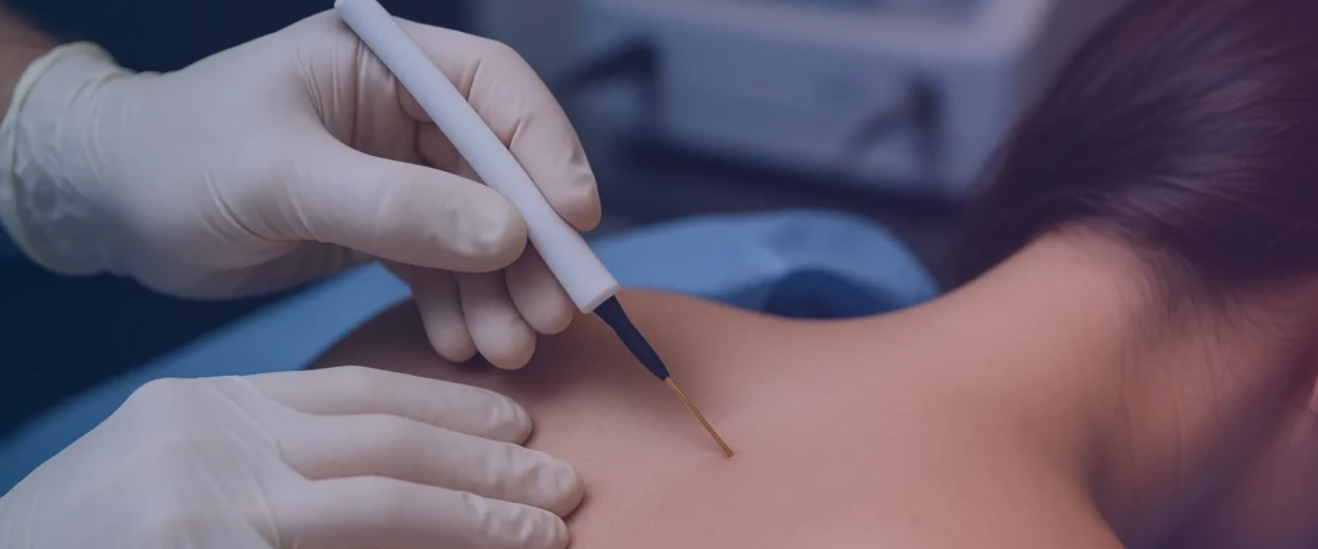 Understanding Pulsed Radiofrequency Neuromodulation for Pain Relief – PAIN